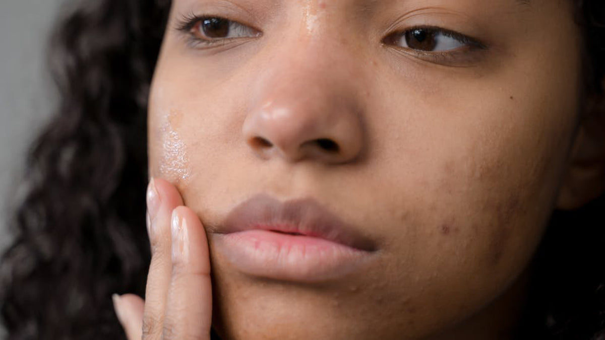 Stuf Skin Blog How Do Hormones Affect Your Skin